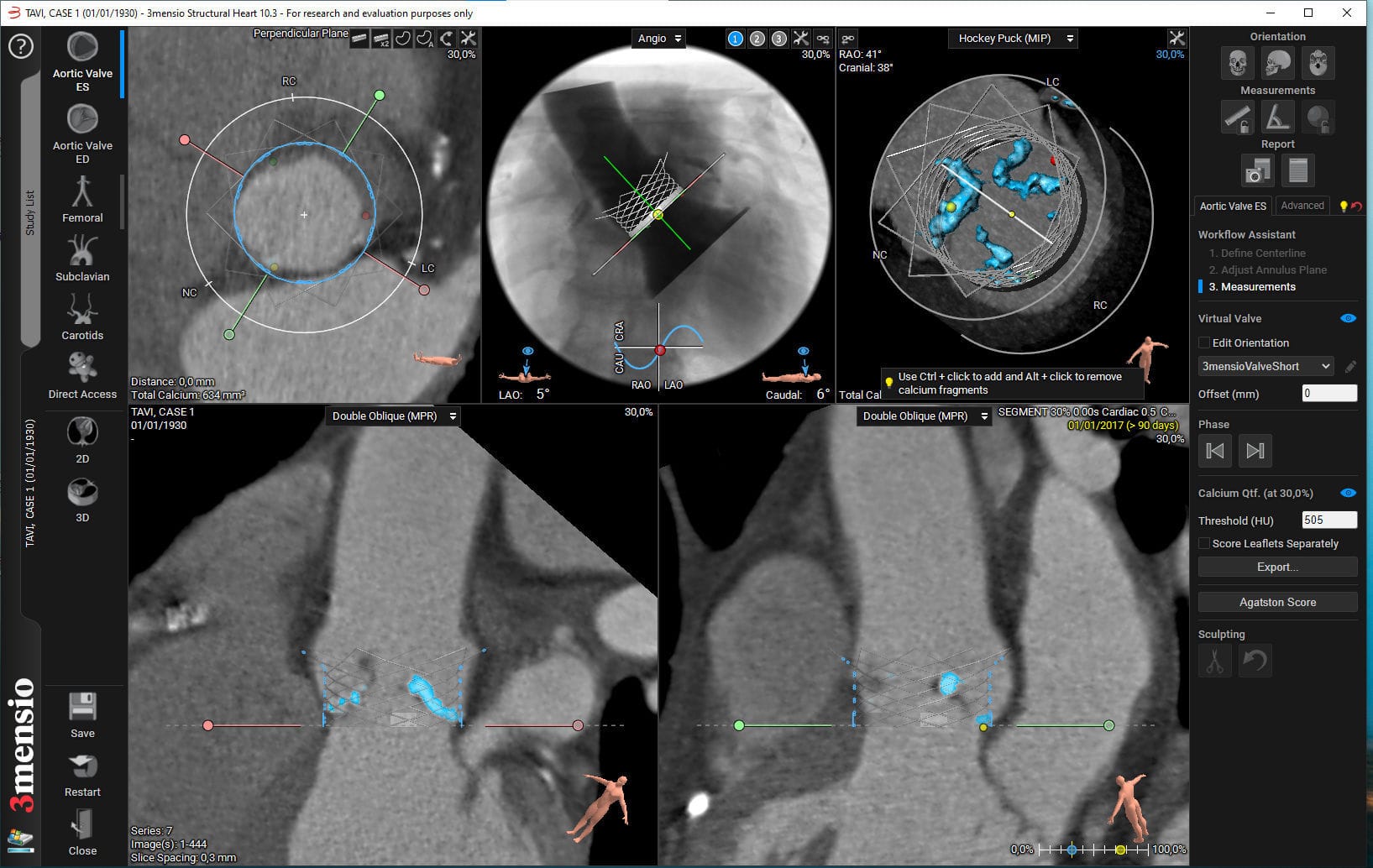 Medical software - 3mensio Aortic valve - Pie Medical Imaging - CT ...