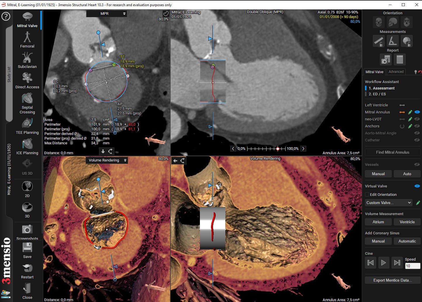 CT software - 3mensio Mitral Valve - Pie Medical Imaging - for ...