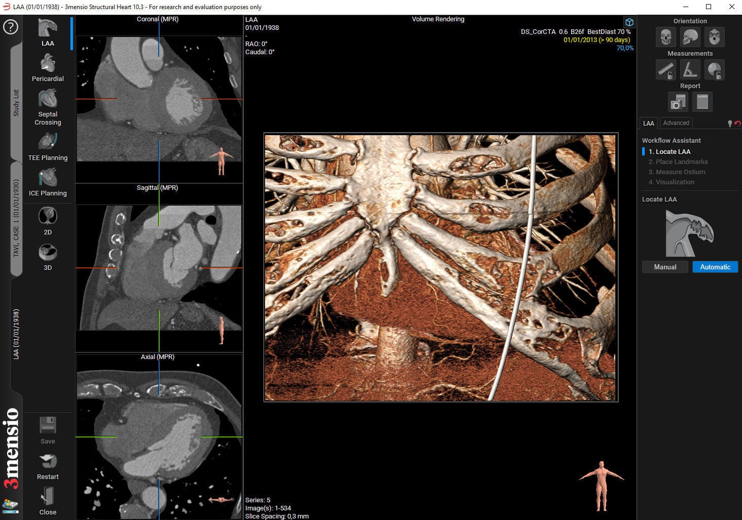 Medical software module - 3mensio LAA - Pie Medical Imaging ...