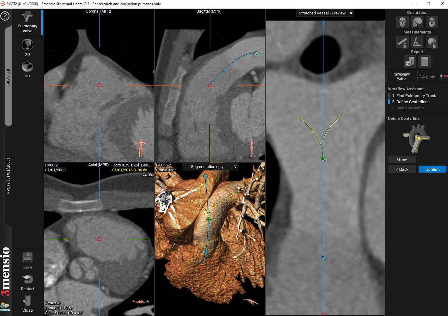 Anatomy software - 3mensio Pulmonary valve - Pie Medical Imaging ...