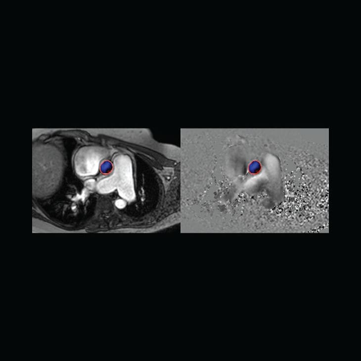 Angiography software - CAAS MR Flow - Pie Medical Imaging - clinical ...