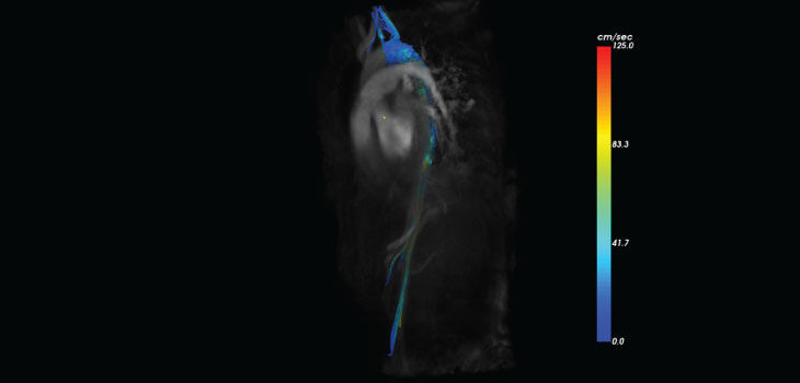 3D viewing software - CAAS MR 4D Flow - Pie Medical Imaging - analysis ...