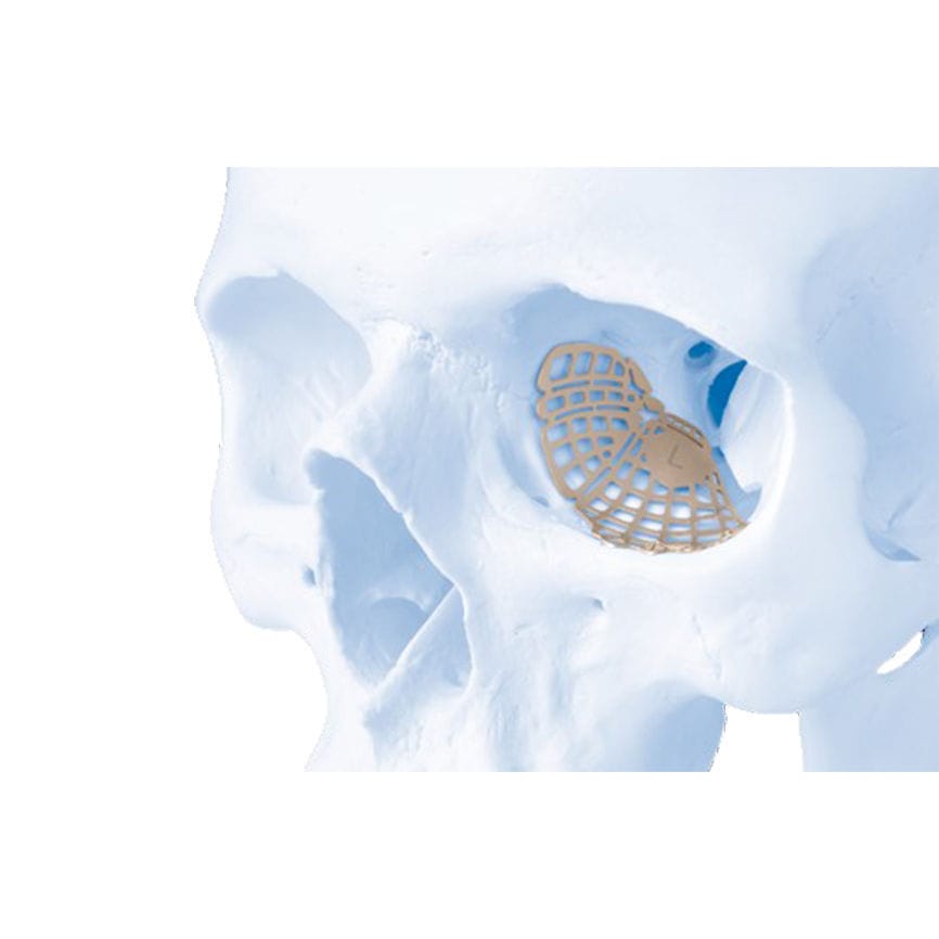 Non-absorbable periorbital implant - MatrixORBITAL™ - Depuy Synthes