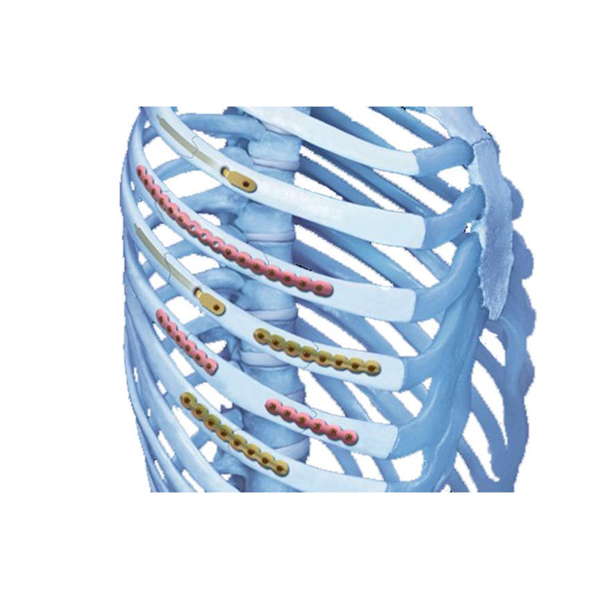 Rib compression plate - MatrixRIB™ - Depuy Synthes - thoracic / locking ...