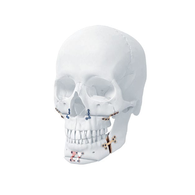 Mandible compression plate - MatrixORTHOGNATHIC™ - Depuy Synthes ...
