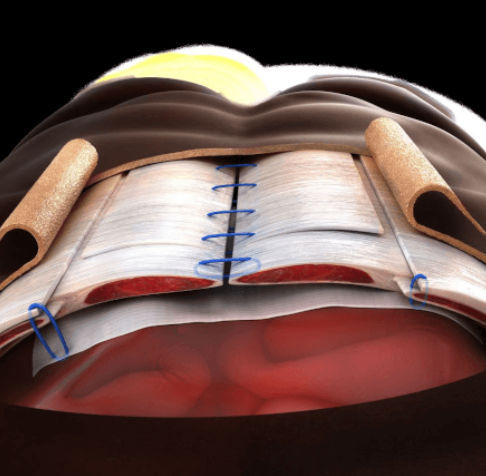 Orthopedic tissue matrix - XCM Biologic™ - Depuy Synthes