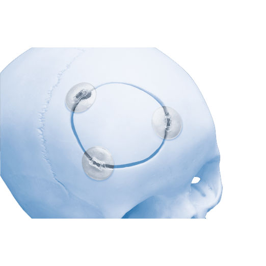 Absorbable cranial fixation system - RAPIDSORB™ - Depuy Synthes