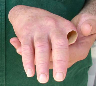 Hand cosmetic prosthesis - Aesthetic Prosthetics - partial / adult