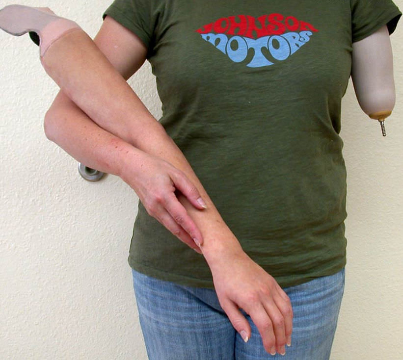 Arm cosmetic prosthesis - Aesthetic Prosthetics - adult