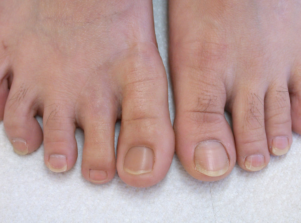 Toe cosmetic prosthesis / adult - Aesthetic Prosthetics