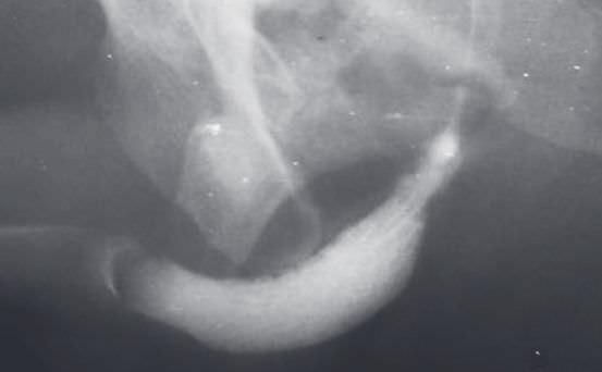 Urethral stent - BUS - Allium Medical Solutions - Videos