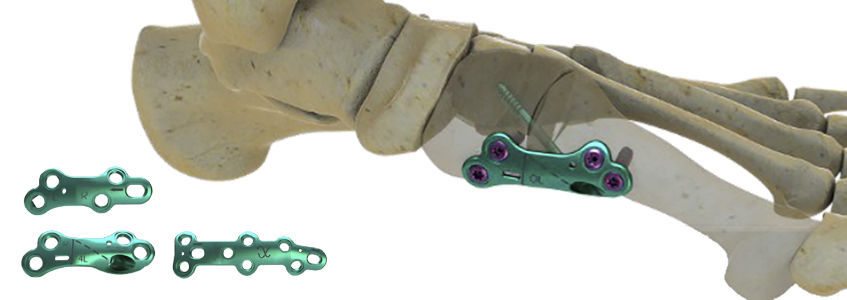 Metatarsophalangeal joint arthrodesis plate - MEDIALMAX™ - Wright ...