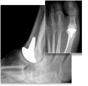 Toe implant - MDI™ - Wright Medical Technology - metatarsophalangeal ...