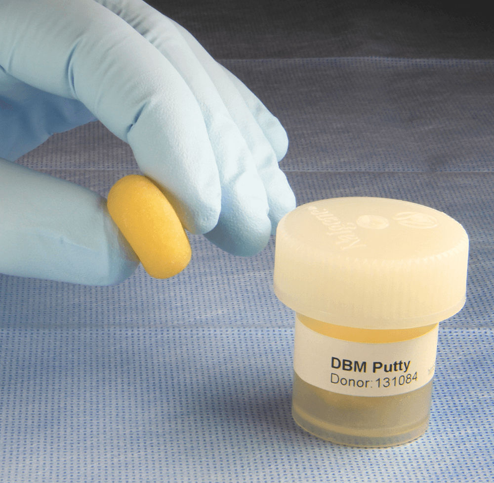 Allograft bone substitute - AlphaGRAFT® - Alphatec Spine - for ...