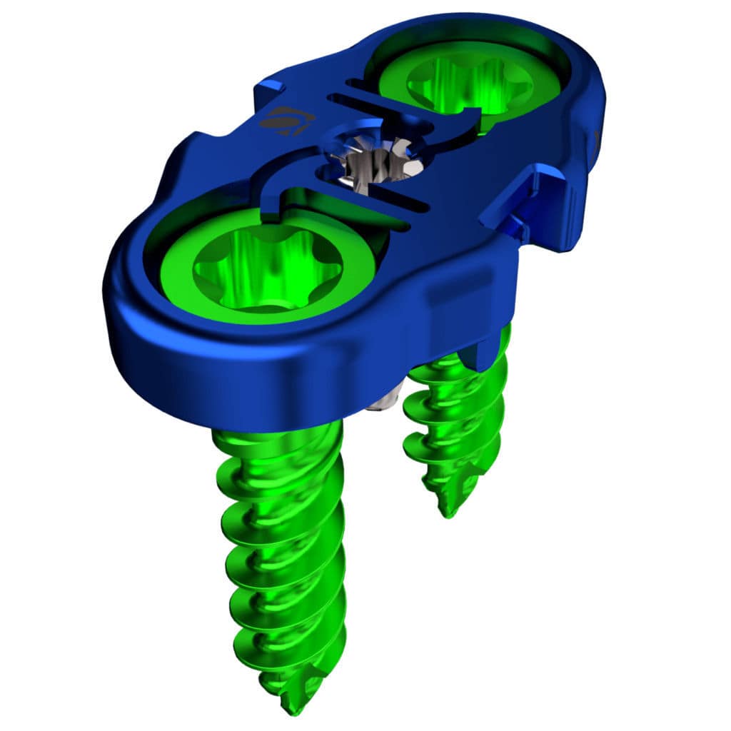 Lumbar vertebra arthrodesis plate - AMP™ - Alphatec Spine - lateral / locking