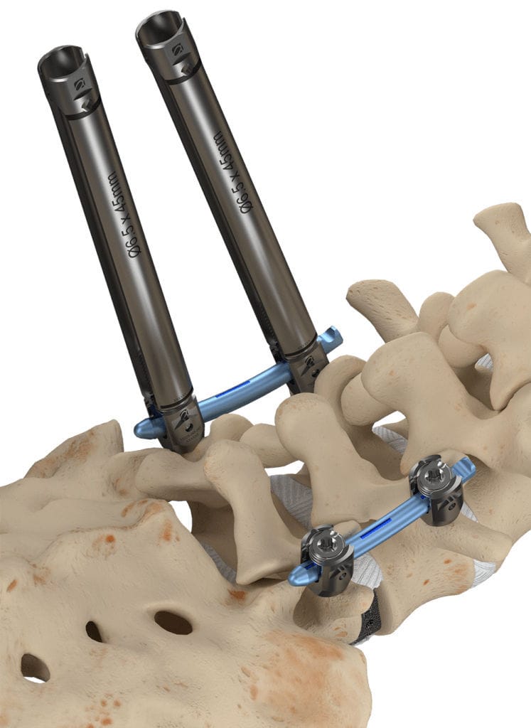 Minimally invasive pedicle screw positioning system - Invictus™ - Alphatec Spine