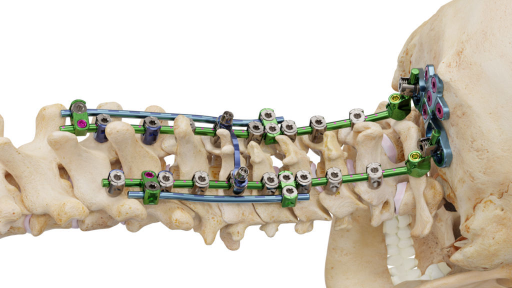 Occipito-cervico-thoracic osteosynthesis unit - Invictus® OCT - Alphatec Spine - posterior / adult