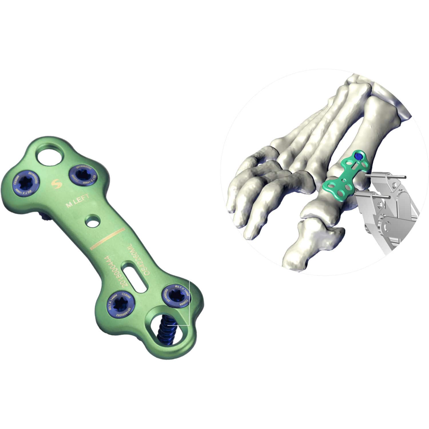 Forefoot arthrodesis plate - UltOS™ - Ortho Solutions - foot phalange ...