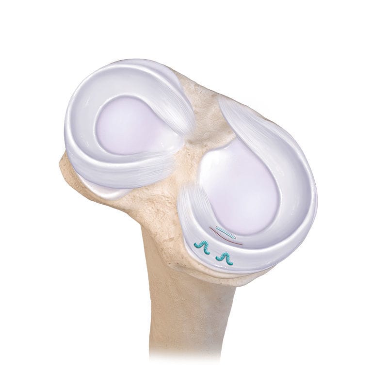 Meniscus suture anchor - FiberStitch™ - Arthrex - non-absorbable