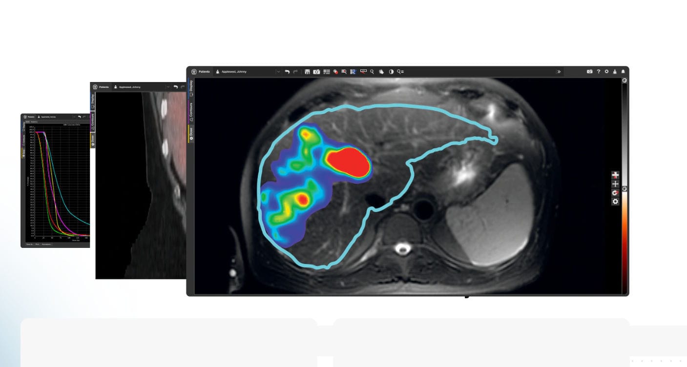 Radiation dose monitoring software - MIM SurePlan™ LiverY90 - MIM ...