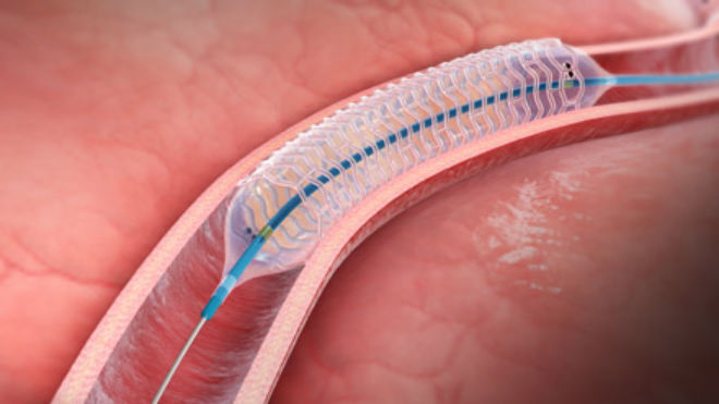 Coronary stent - DESolve™ - Elixir Medical - PLLA / bioresorbable