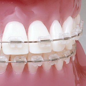 Aesthetic orthodontic bracket - Prism™ - G&H Orthodontics - transparent