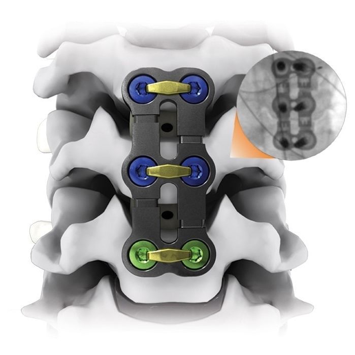 Cervical arthrodesis plate - KINETIC® - Life Spine - locking / metallic ...