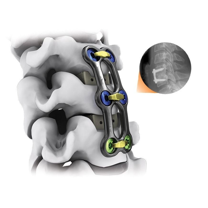 Cervical arthrodesis plate - NEO® - Life Spine - locking / metallic / 2 ...