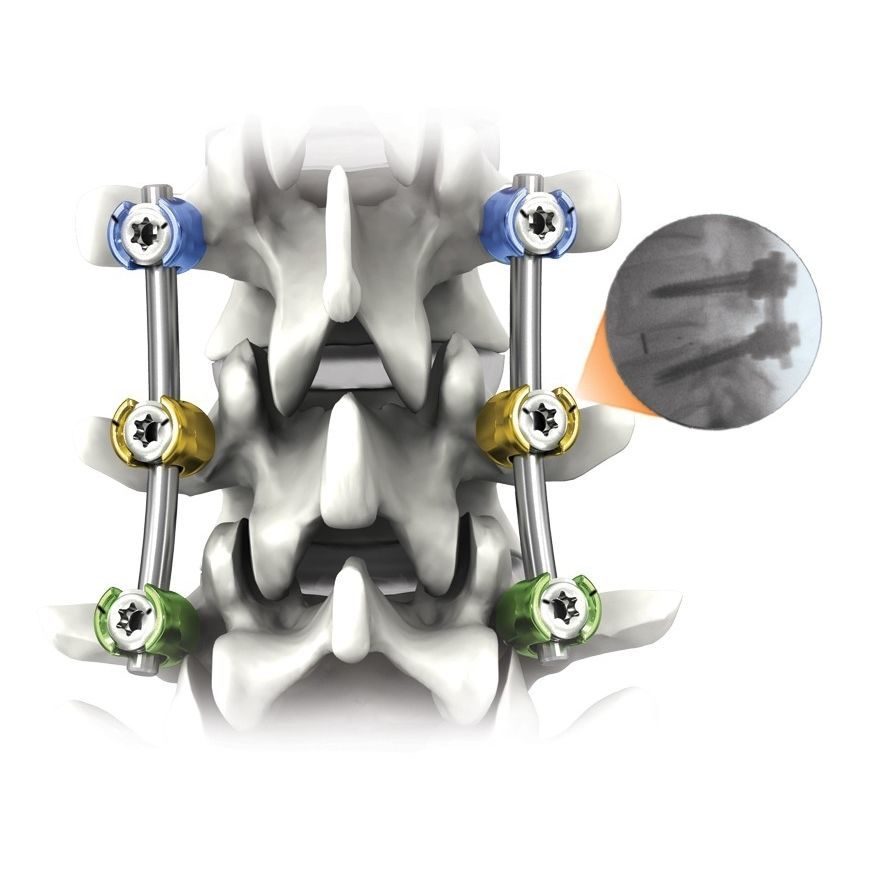 Thoraco-lumbar osteosynthesis unit - NAUTILUS® - Life Spine - posterior ...
