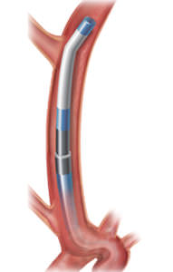 Catheter guidewire - Chaperon® - MicroVention - hydrophilic