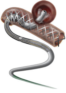 Access microcatheter - Headway® - MicroVention - blood vessel / human