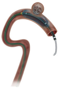 Occlusion catheter - Scepter C® - MicroVention - blood vessel / balloon ...