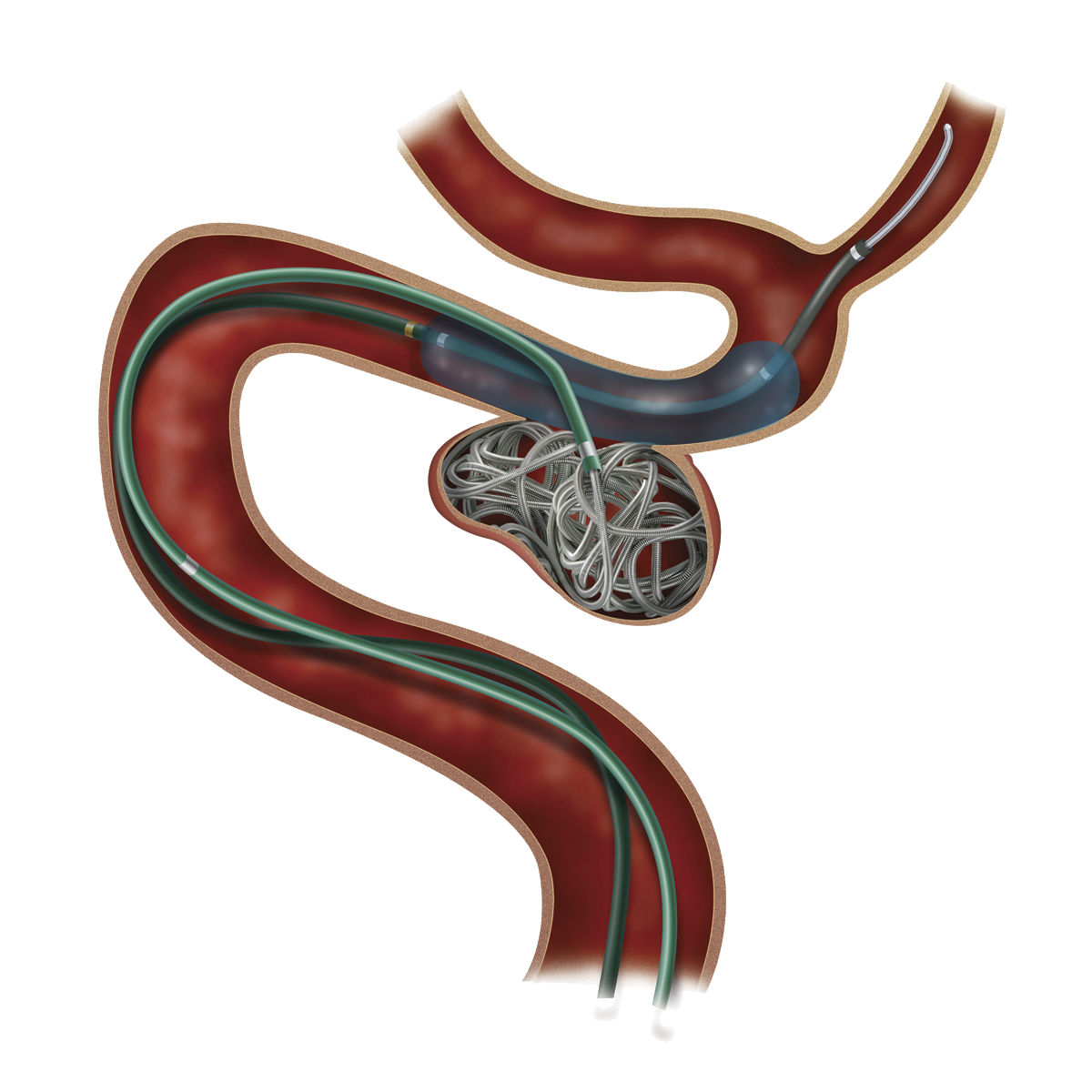Transseptal access sheath - Headway® Duo - MicroVention