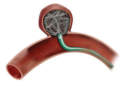 Embolization coil - HyperSoft® 3D - MicroVention