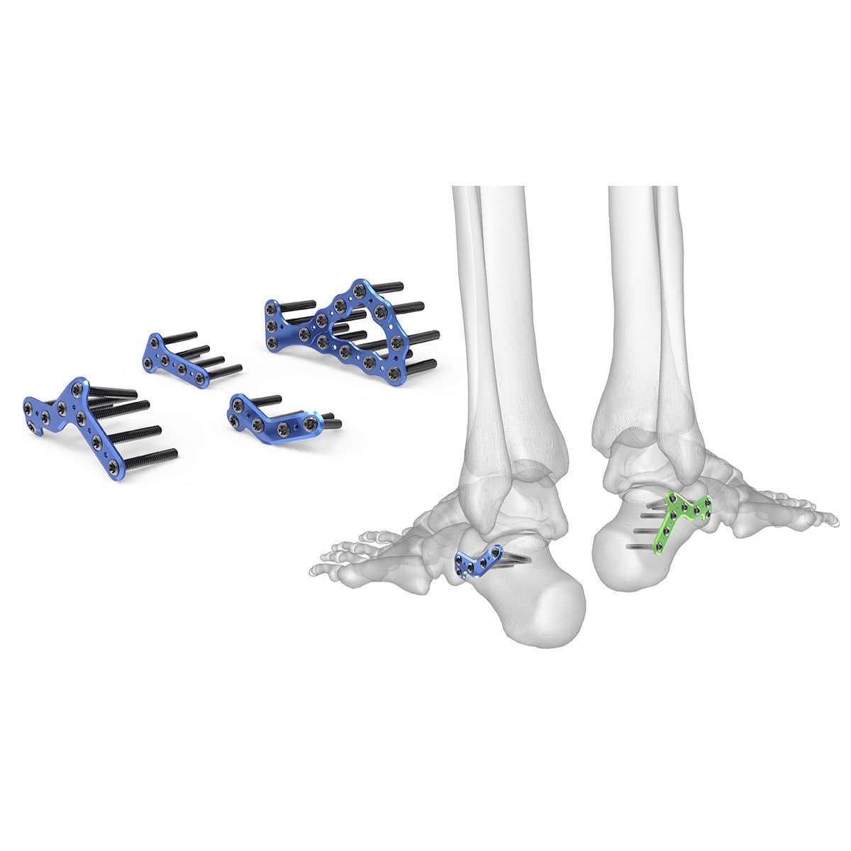 Calcaneus compression plate - 70-0 series - Acumed - lateral / medial ...