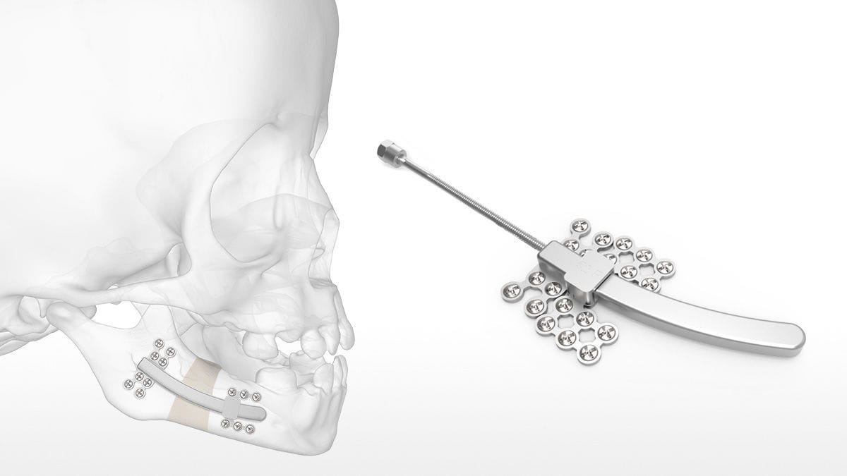Mandibular distractor - Logic™ Jr - Acumed - internal / pediatric