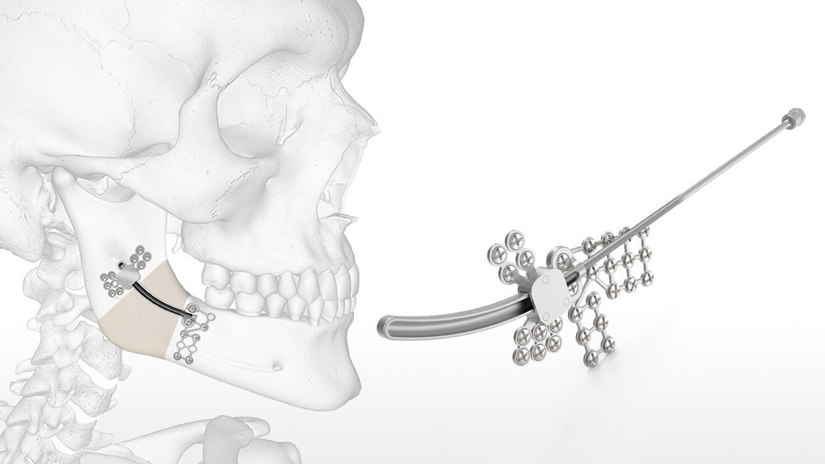 Mandibular distractor - Logic ™ - Acumed - internal / adult