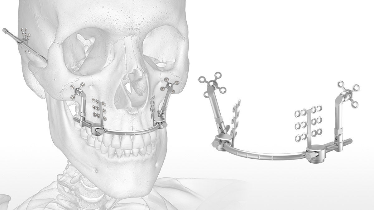 Maxillary distractor - Spectrum™ - Acumed - internal / adult