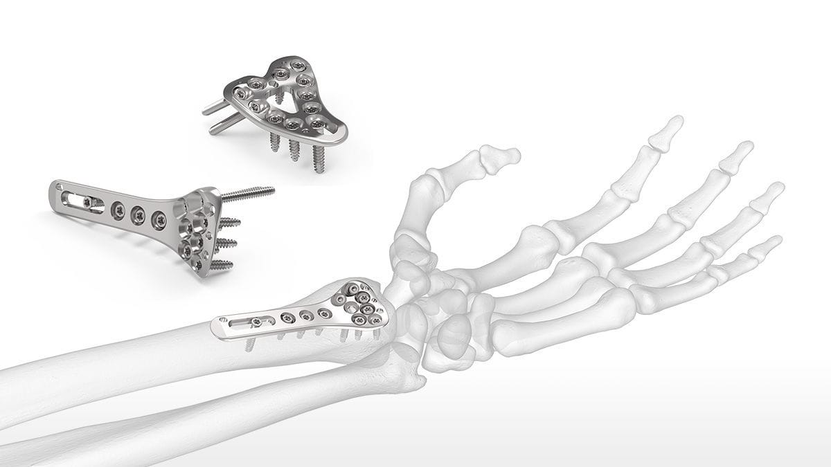 Radius compression plate - ExtremiLock™ - Acumed - wrist / distal / locking