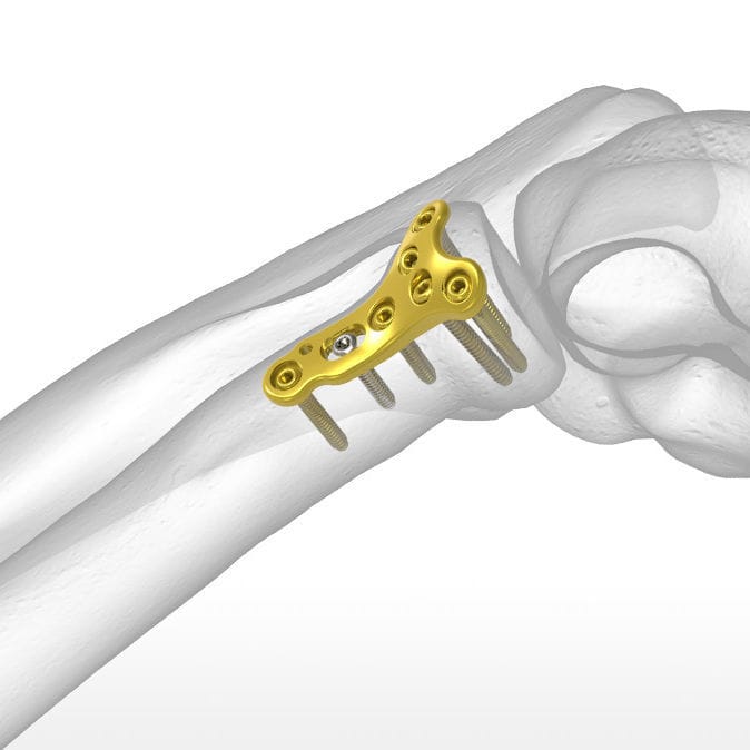 Radial head compression plate - 70-0098 - Acumed - distal / proximal ...