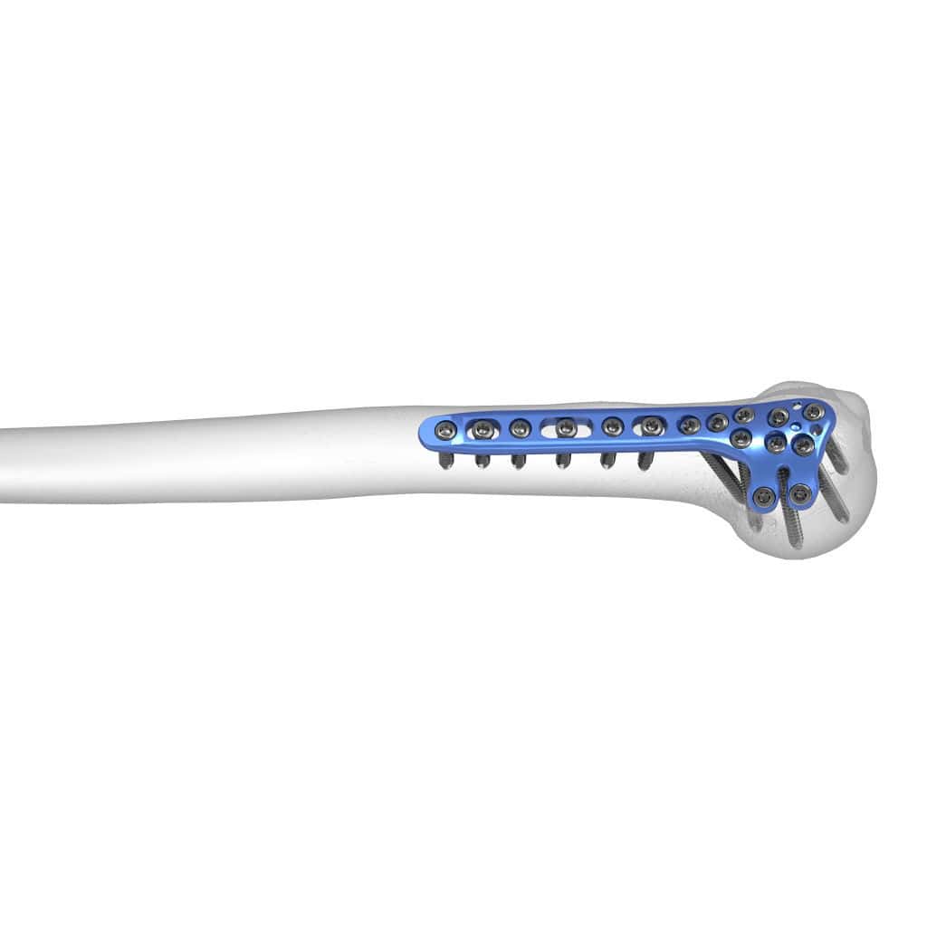 Humerus compression plate - Polarus 3 - Acumed - proximal / medial ...