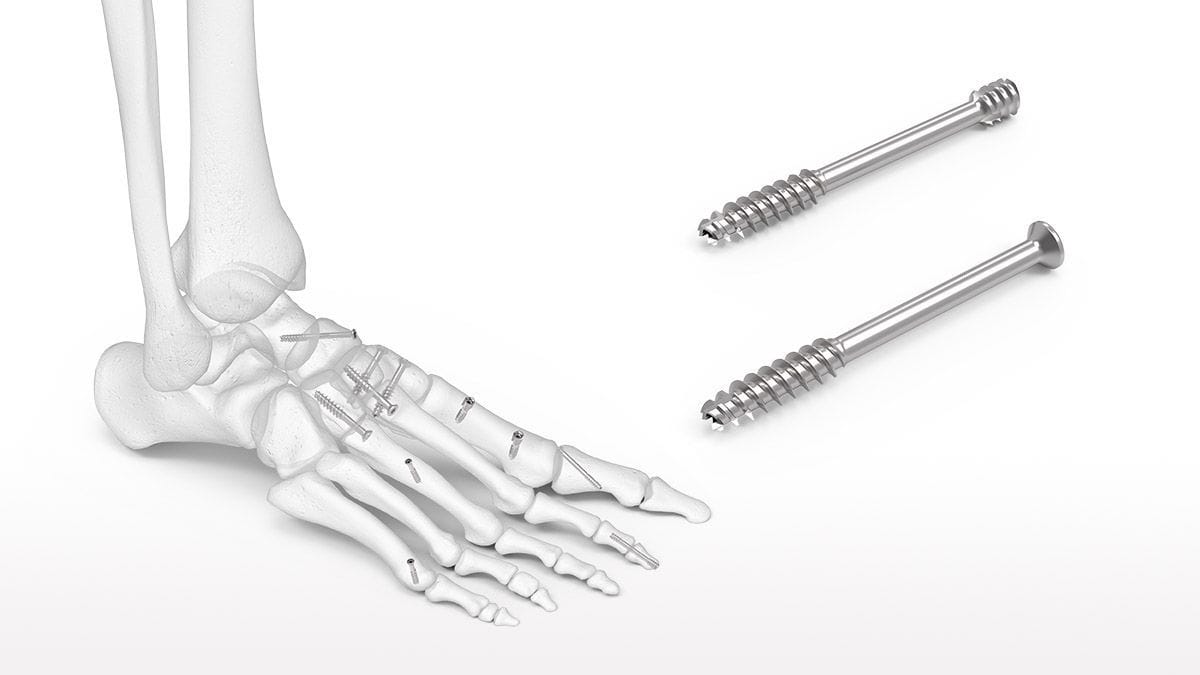 Hindfoot compression bone screw - ExtremiFix™ - Acumed - ankle ...