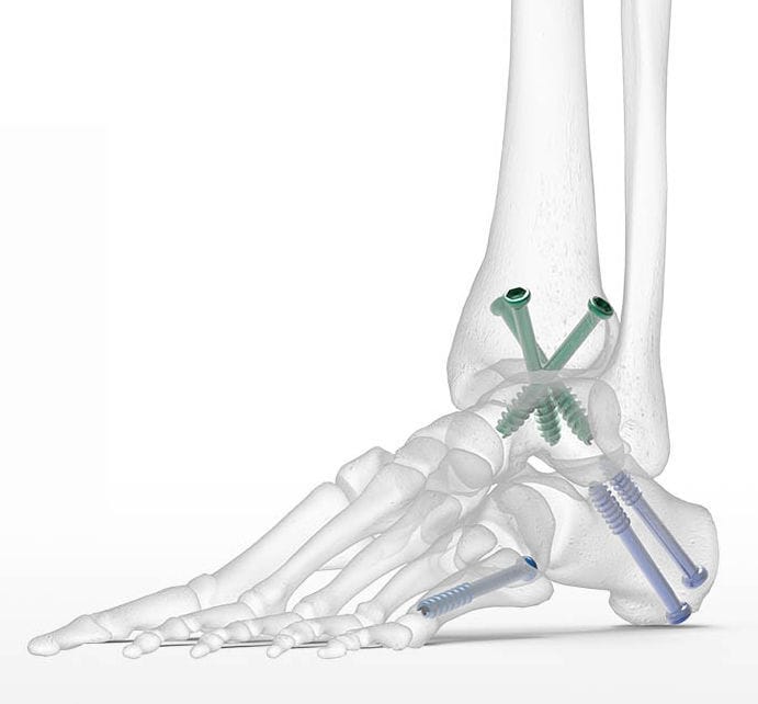 Foot compression bone screw - Acumed - cannulated / metallic