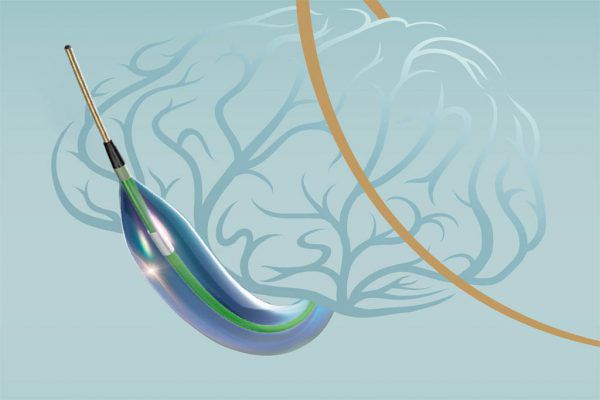Dilatation catheter - Neuro LPS™ - SINOMED - neurological / balloon