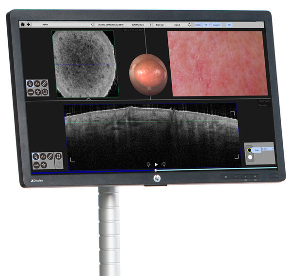 Skin layer OCT skin analysis system - VivoSight - Michelson Diagnostics ...