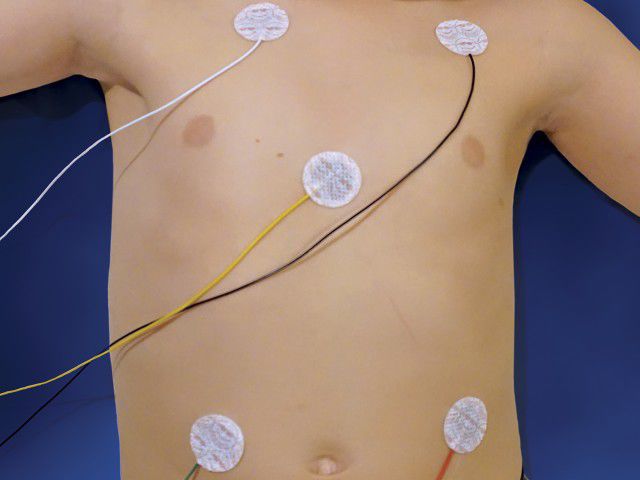 Pediatric ECG electrode - NeoLead® - Neotech Products - monitoring ...