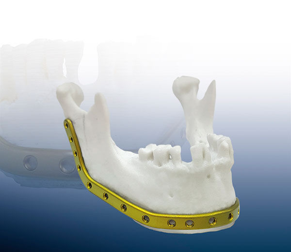 Mandible compression plate - REAL FIT - OSTEONIC - locking / titanium