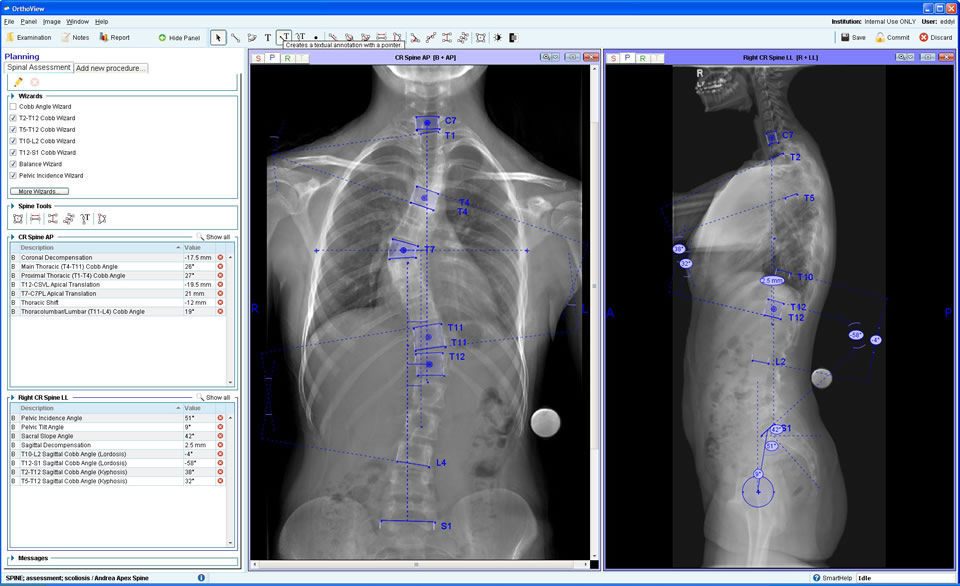 Management software module - Spinal Deformity Assessment - OrthoView ...
