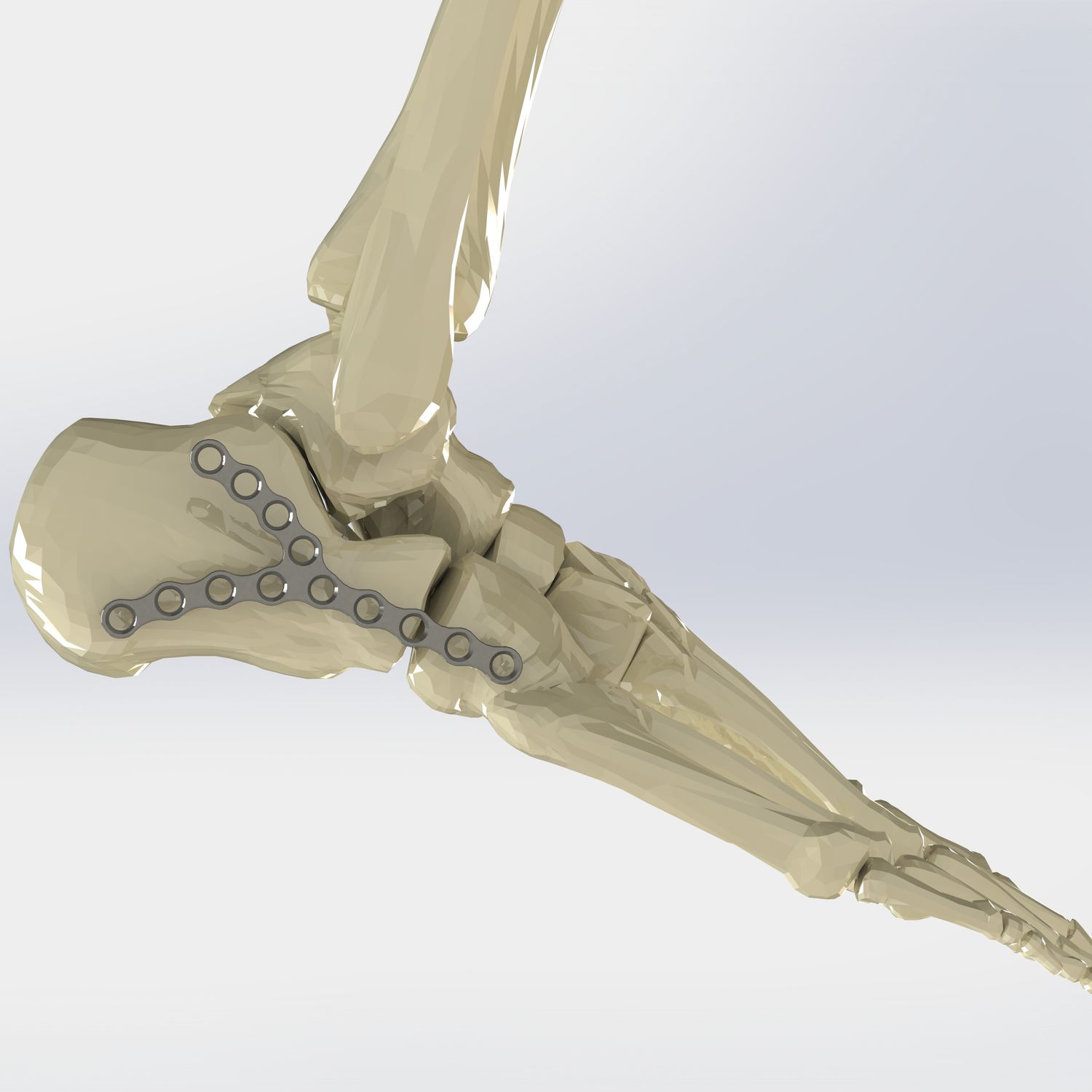 Calcaneus compression plate - 36.380.13 - Medicalex - non-locking ...