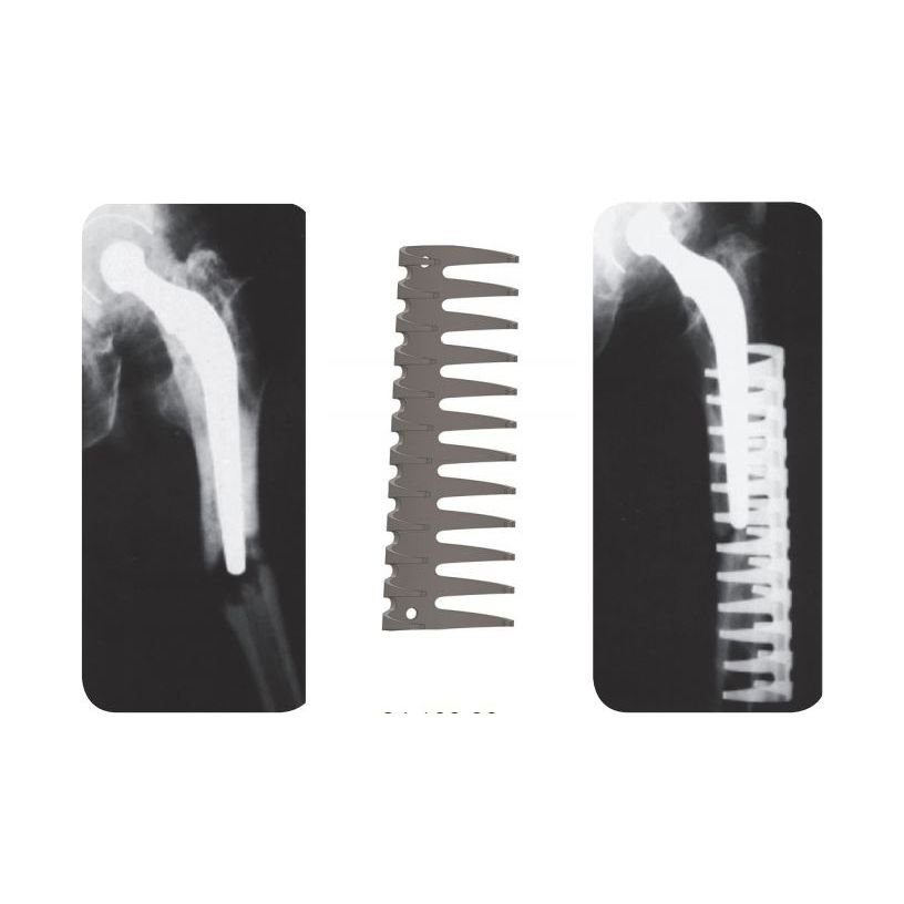 Femoral periprosthetic plate - 34.100.00 - Medicalex - non-locking ...